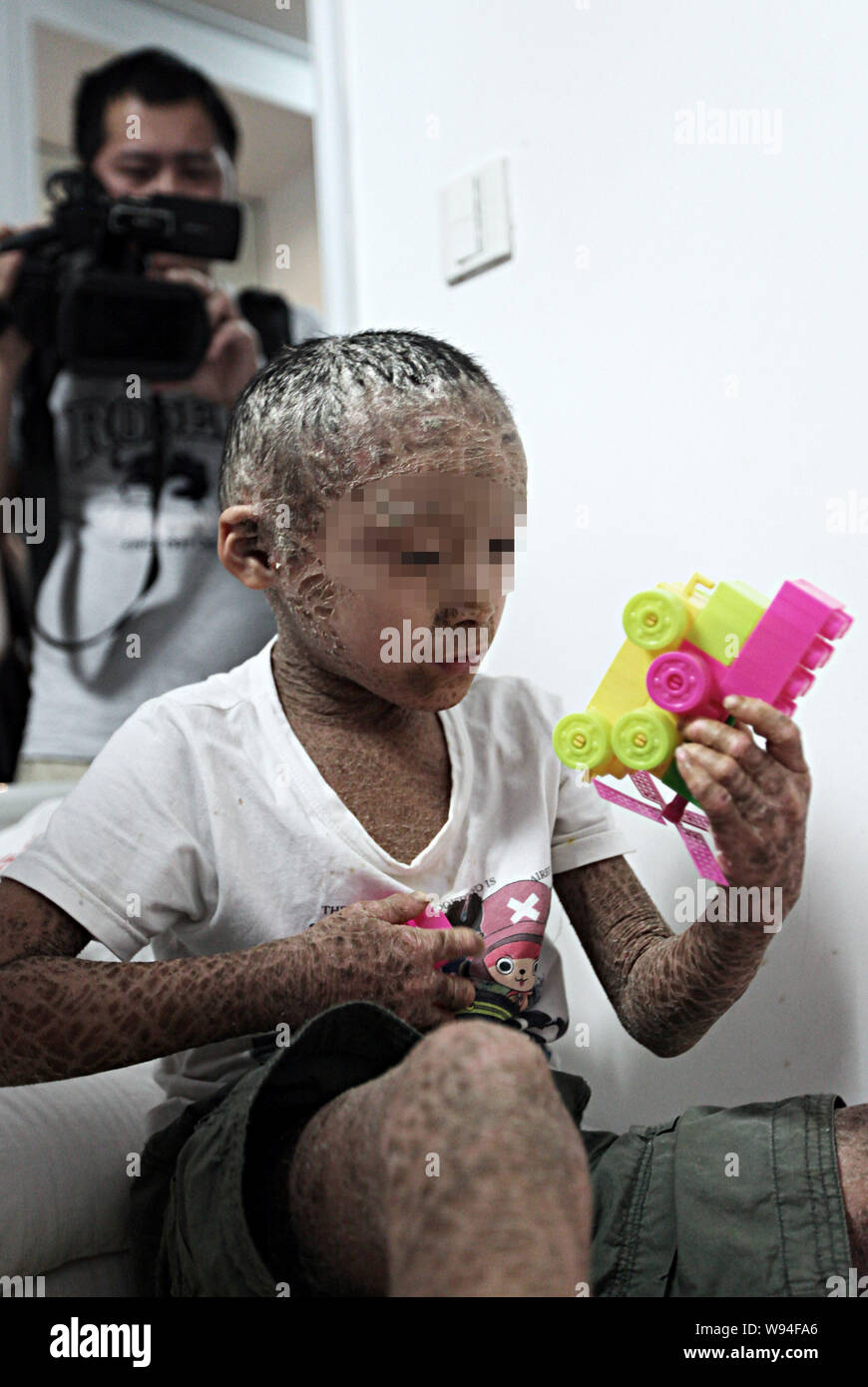 Pan Xianhang, the 8-year-old boy who has fishskin-shaped skin covering ...