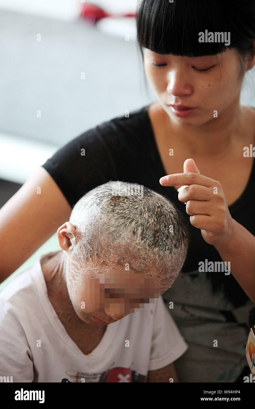 Pan Xianhang, left, an 8-year-old boy who has fishskin-shaped skin ...