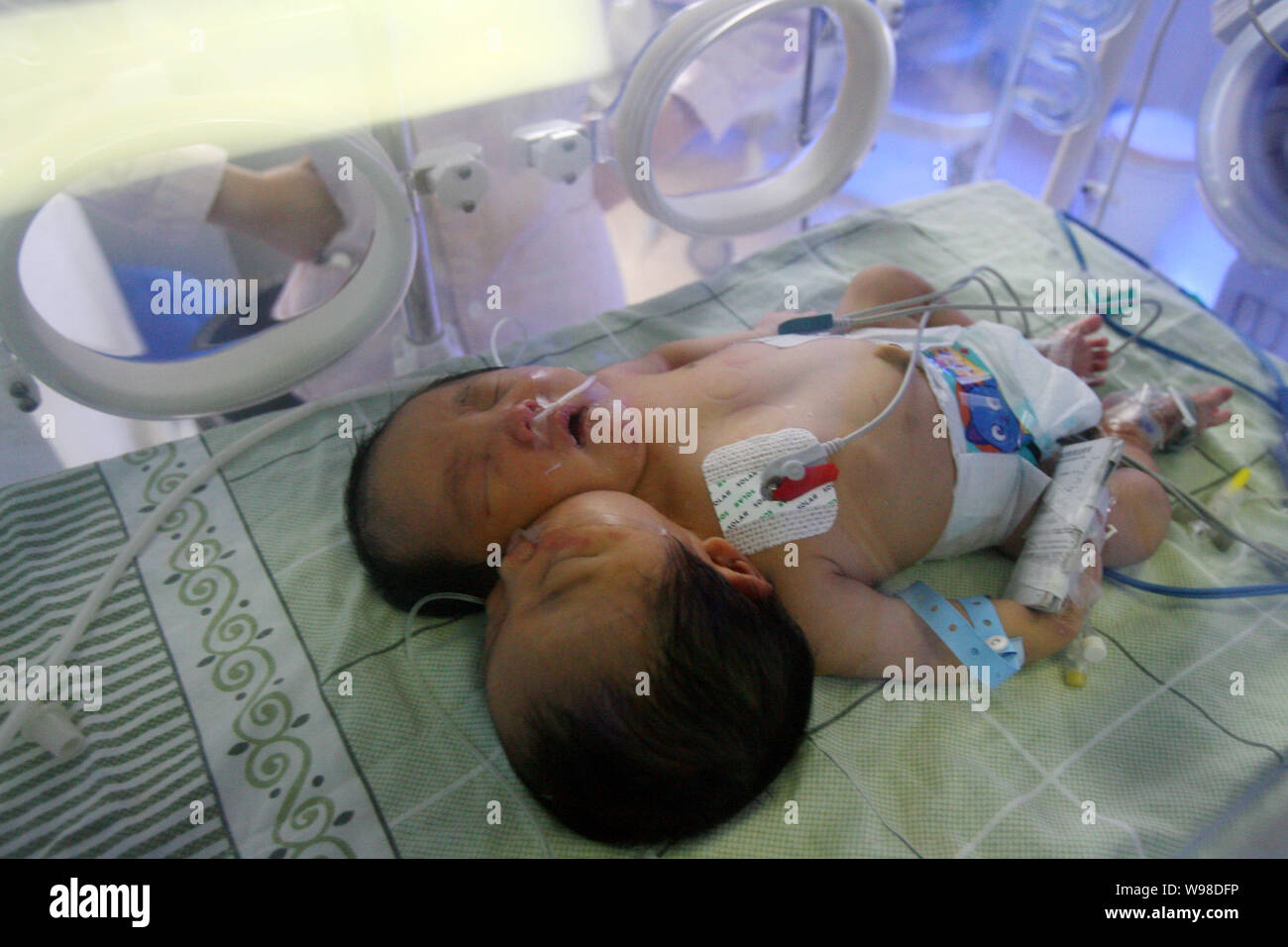 A pair of conjoined twin girls who share a single body are being kept ...