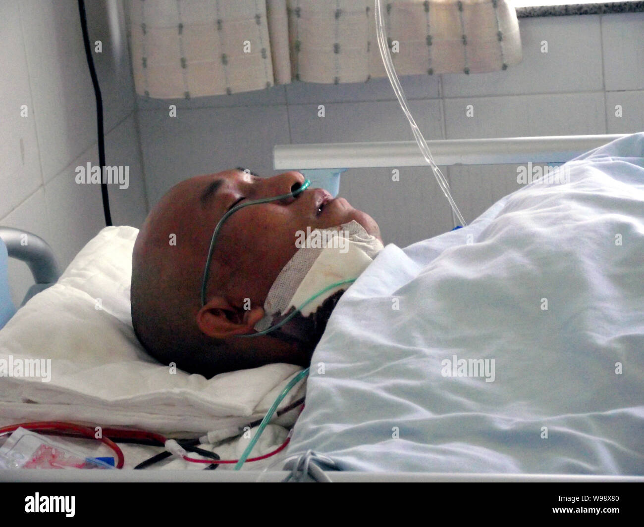 Li Fu rests in the bed after a surgery at a hospital in Yuxi city ...