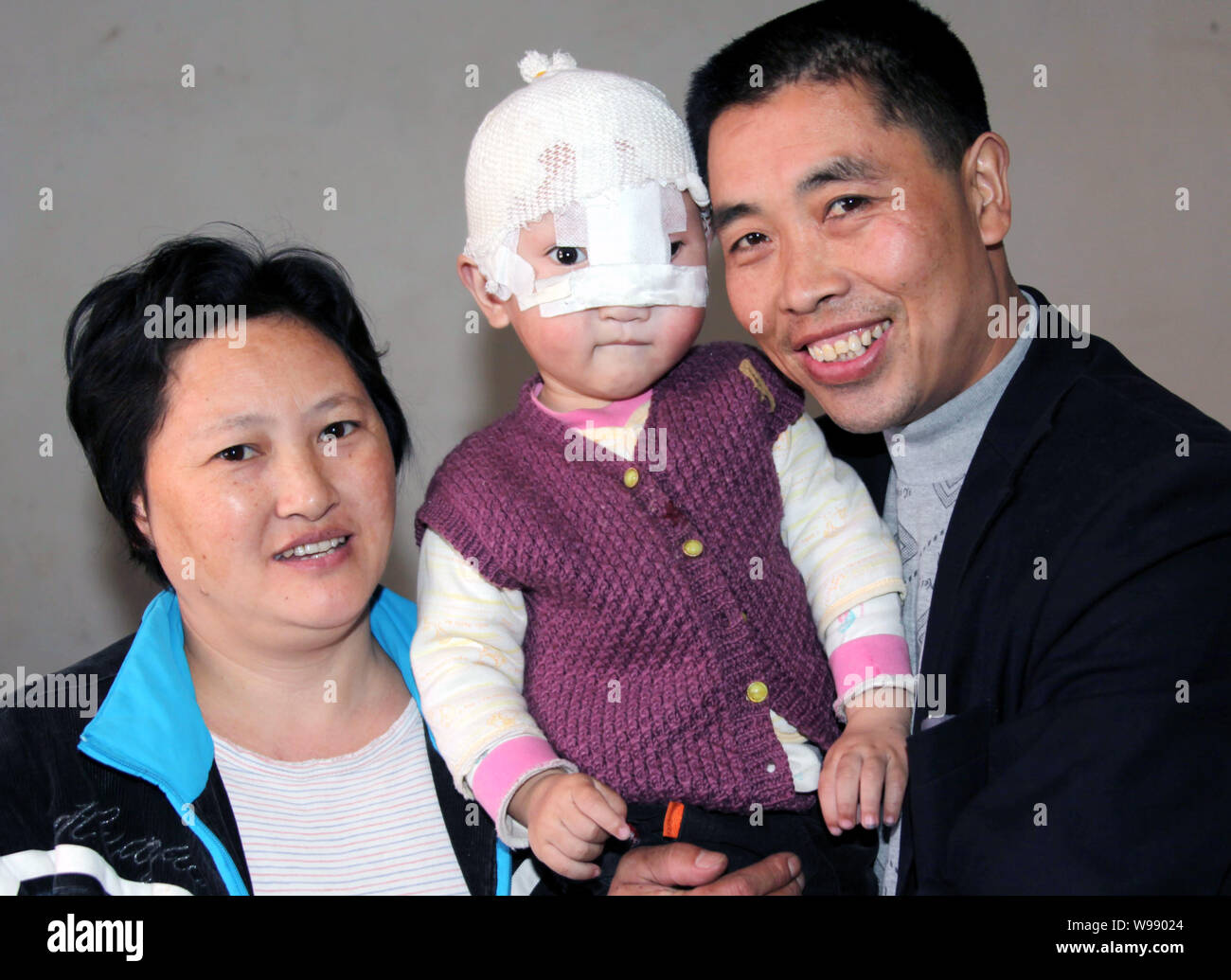Qin Yuhang, who suffered from a facial tumour that covers his left eye ...