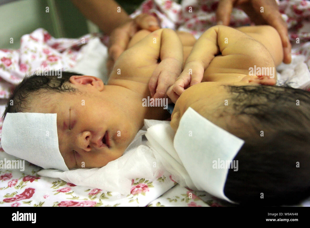 A pair of newborn conjoined twin girls are attended by their ...