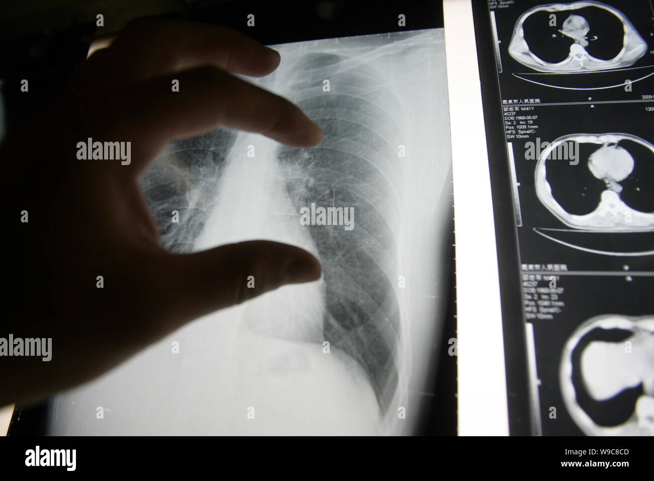 Needle doctor patient chest hi-res stock photography and images - Alamy