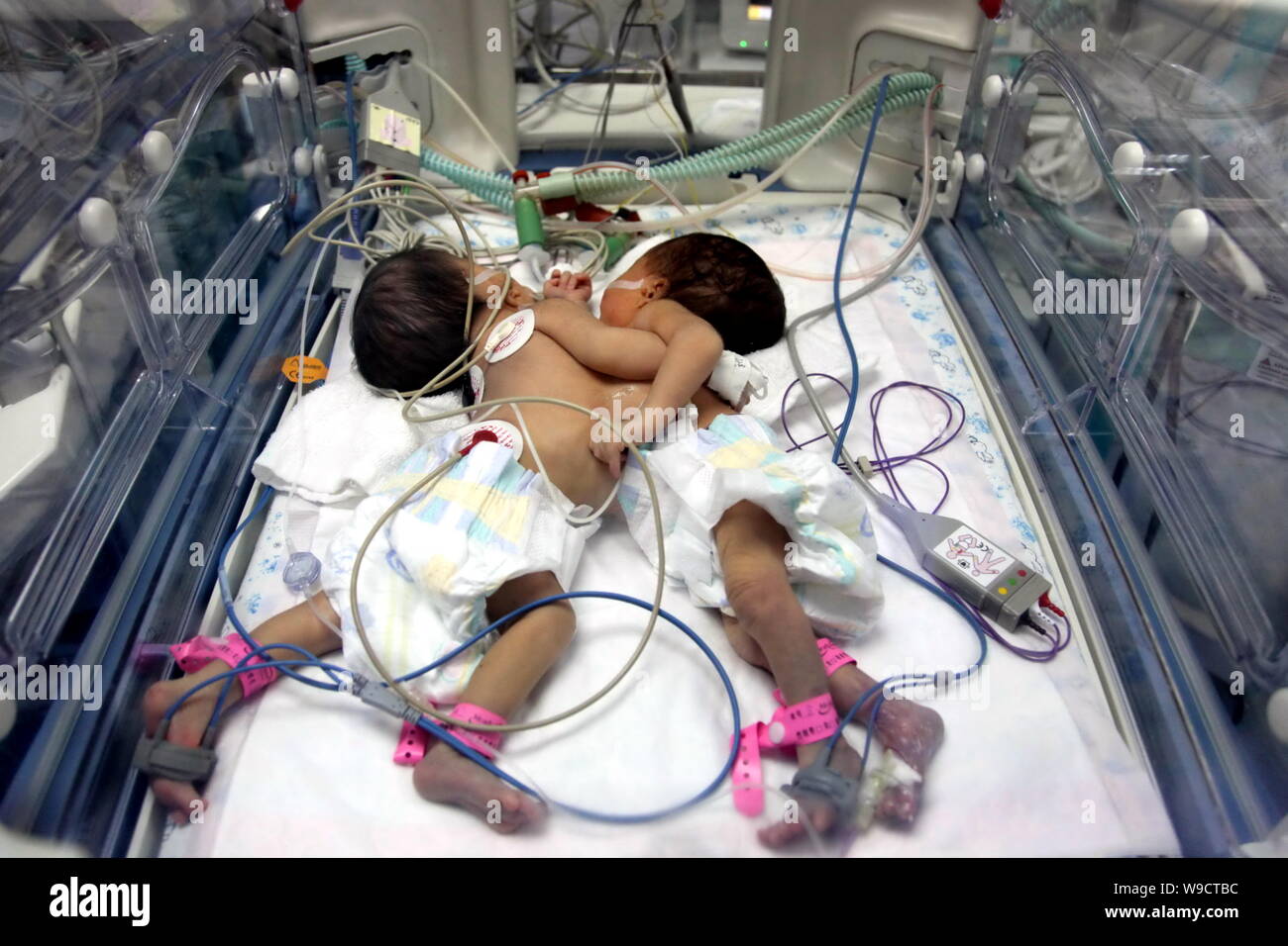 The newborn Siamese twin sisters are seen in an incubator at the Bayi ...
