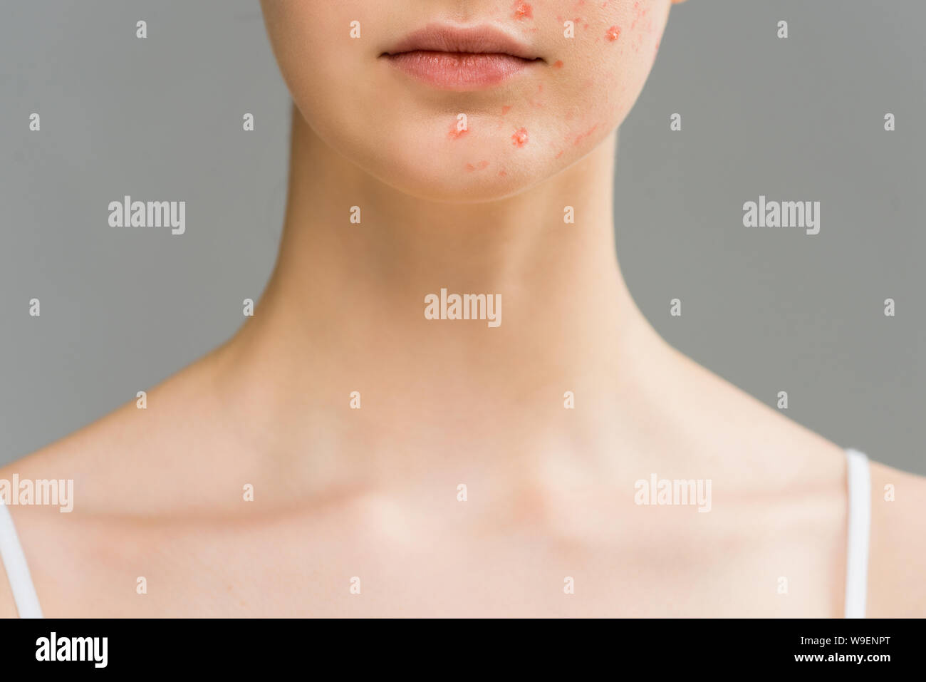Pimples on face hi-res stock photography and images - Alamy