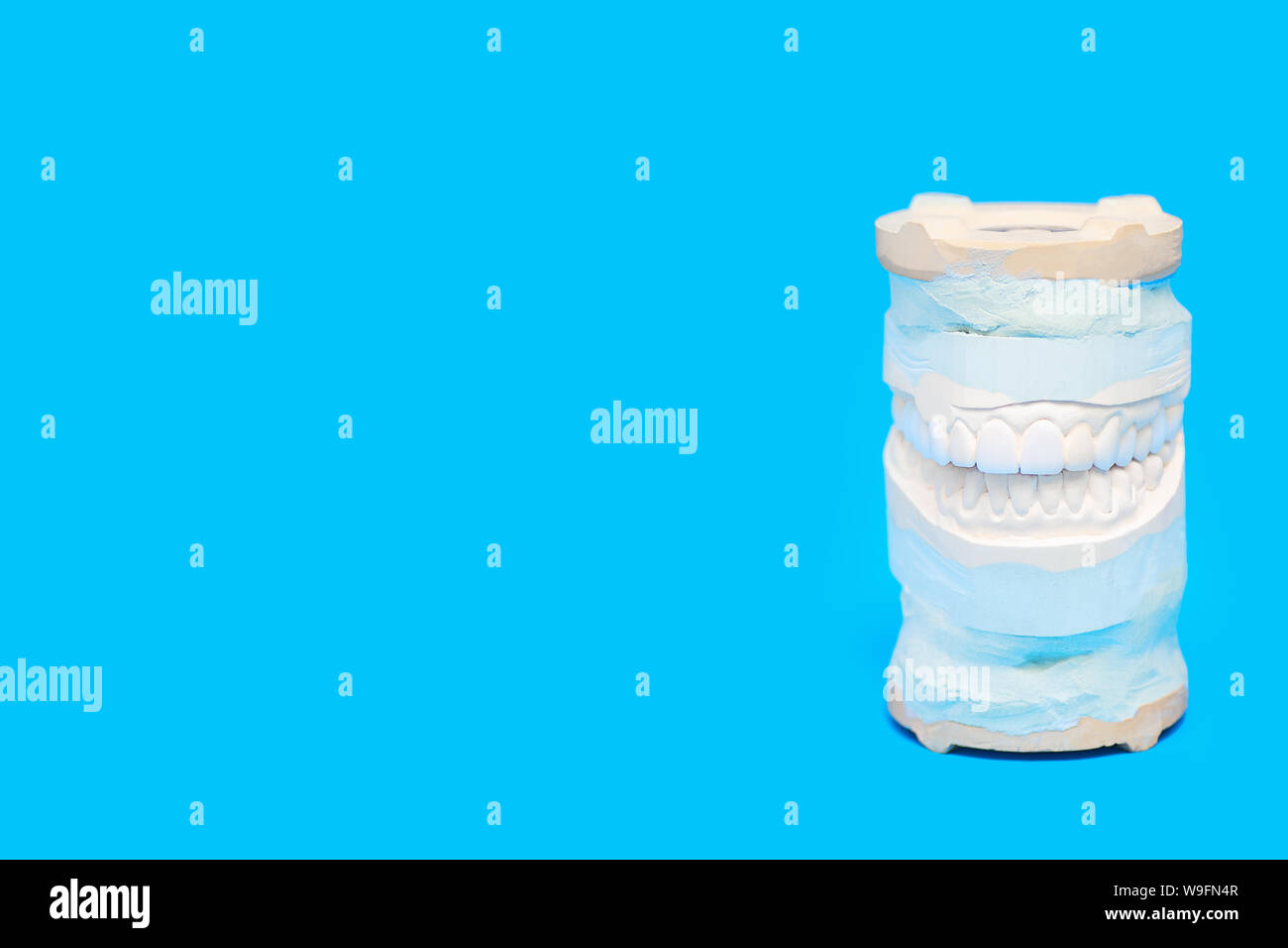 jaw cast in a special medical device on a blue background Stock Photo ...