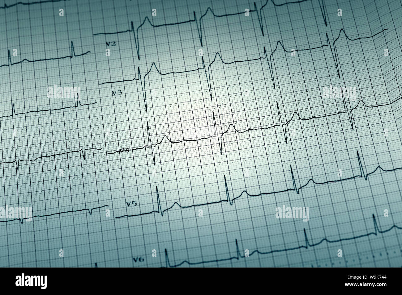 ECG paper graph report, electrocardiogram on paper form as background ...