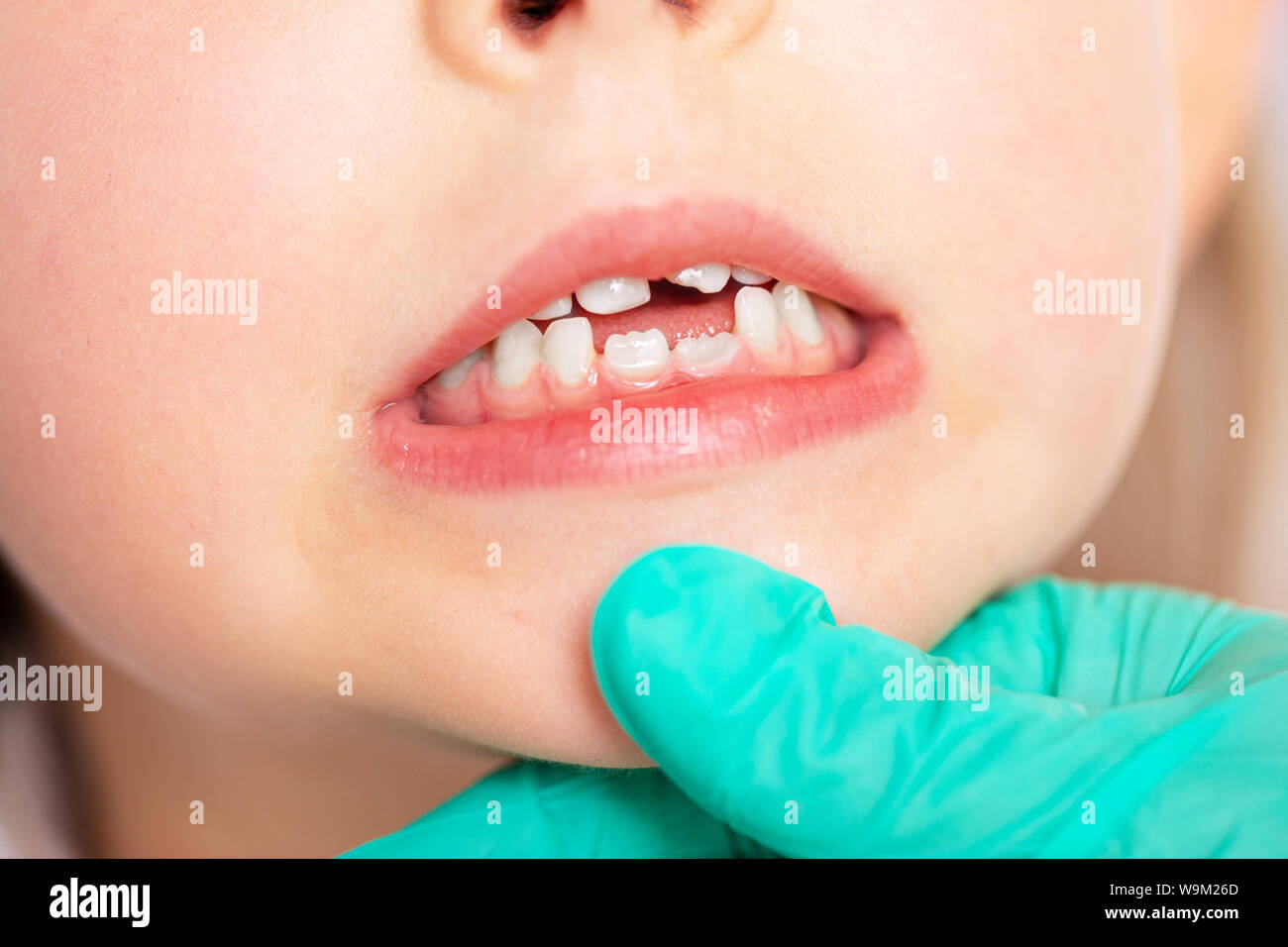 Child incisor teeth hi-res stock photography and images - Alamy