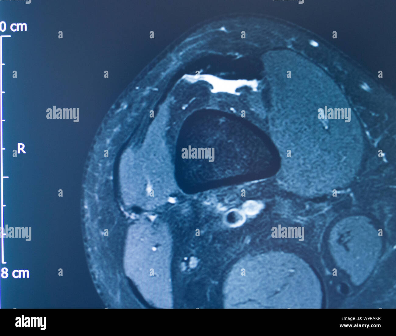 Knee sports injury mri mcl grade 2 tear magnetic resonance imaging ...