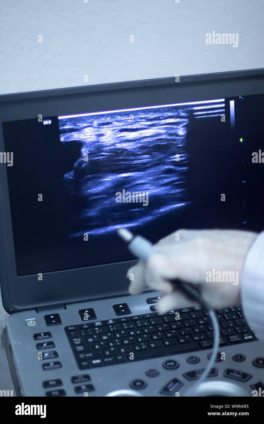 EPI Intratissue Percutaneous Electrolysis dry needling ultrasound ...