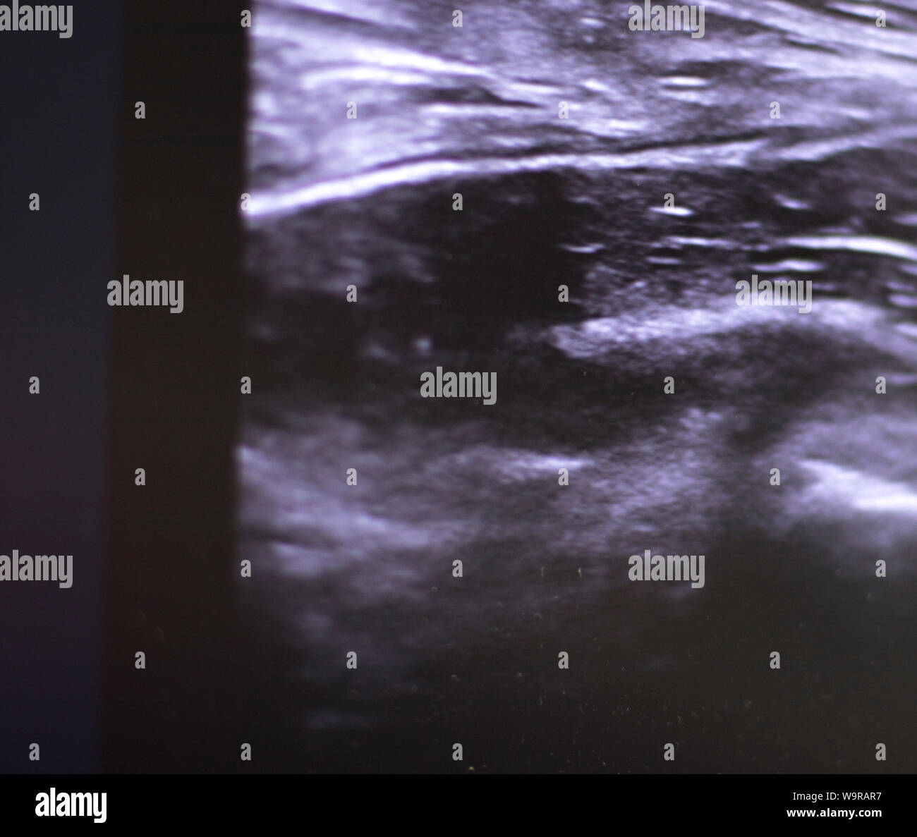 EPI Intratissue Percutaneous Electrolysis dry needling ultrasound ...