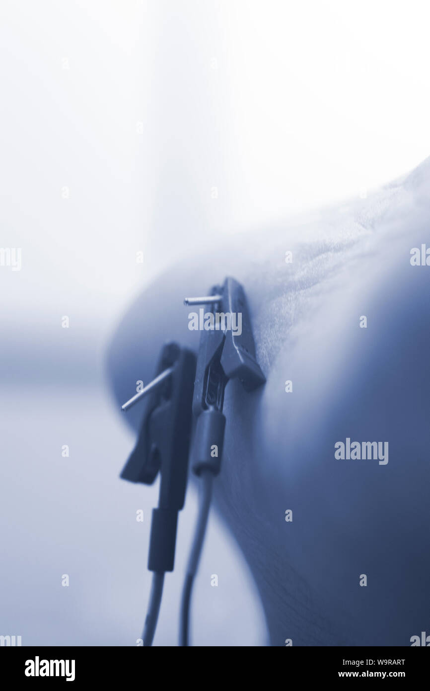 Percutaneous electrolysis therapy hi-res stock photography and images - Alamy