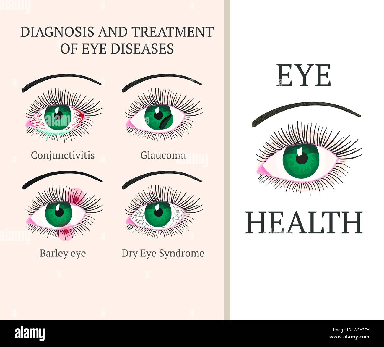 Allergic pink eye Stock Vector Images - Alamy