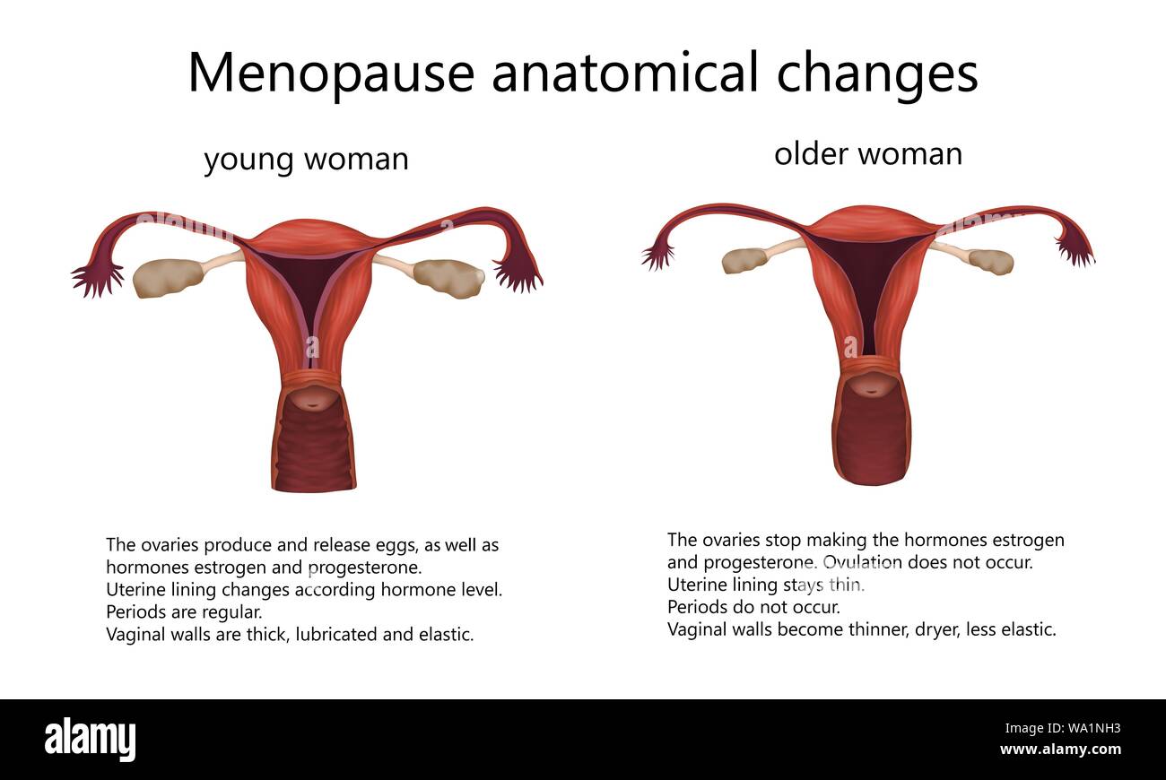 Menopause anatomical changes, illustration. Comparison of the female reproductive systems of a ...