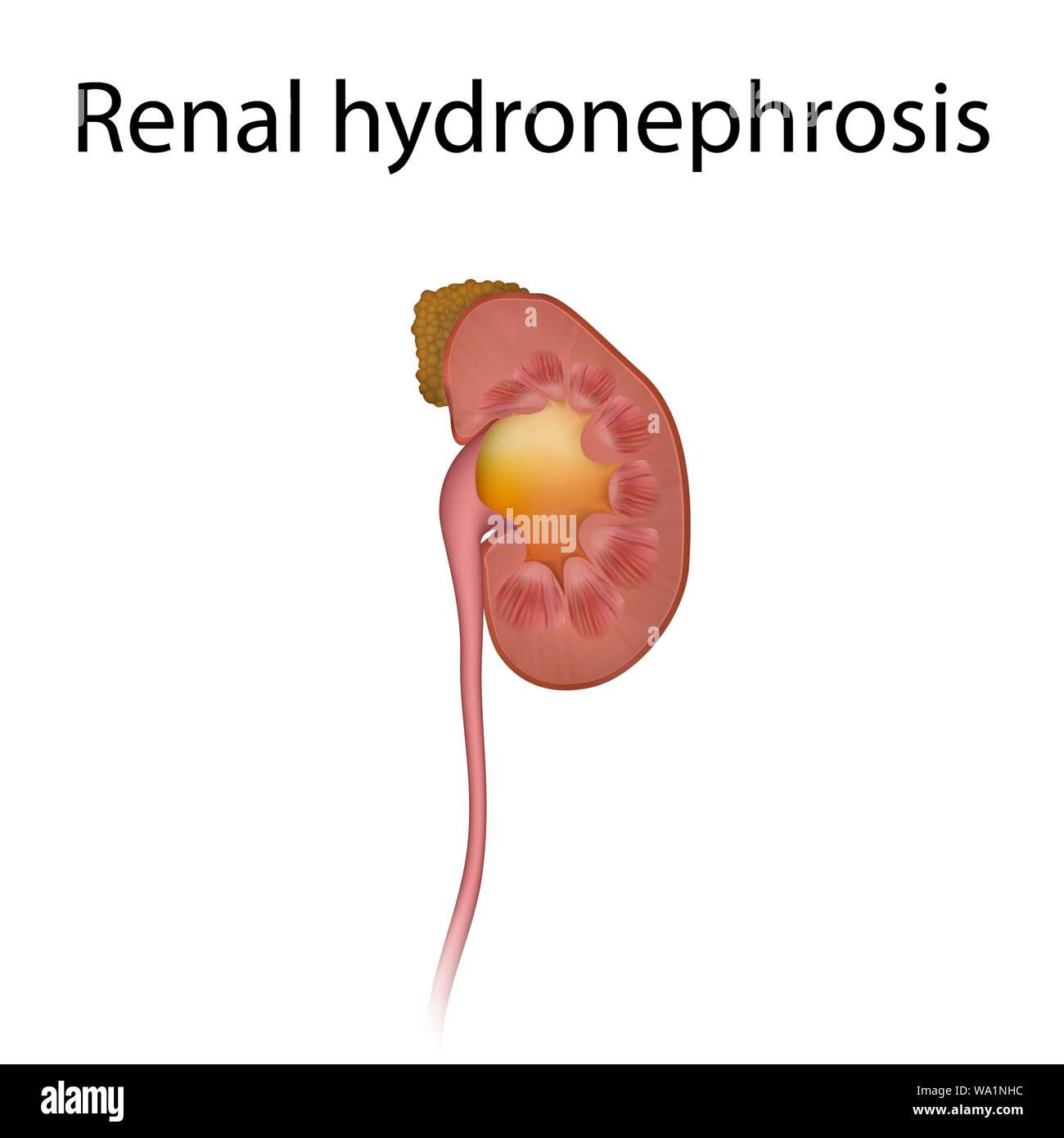 Renal hydronephrosis, illustration. The kidney is unable to drain and ...