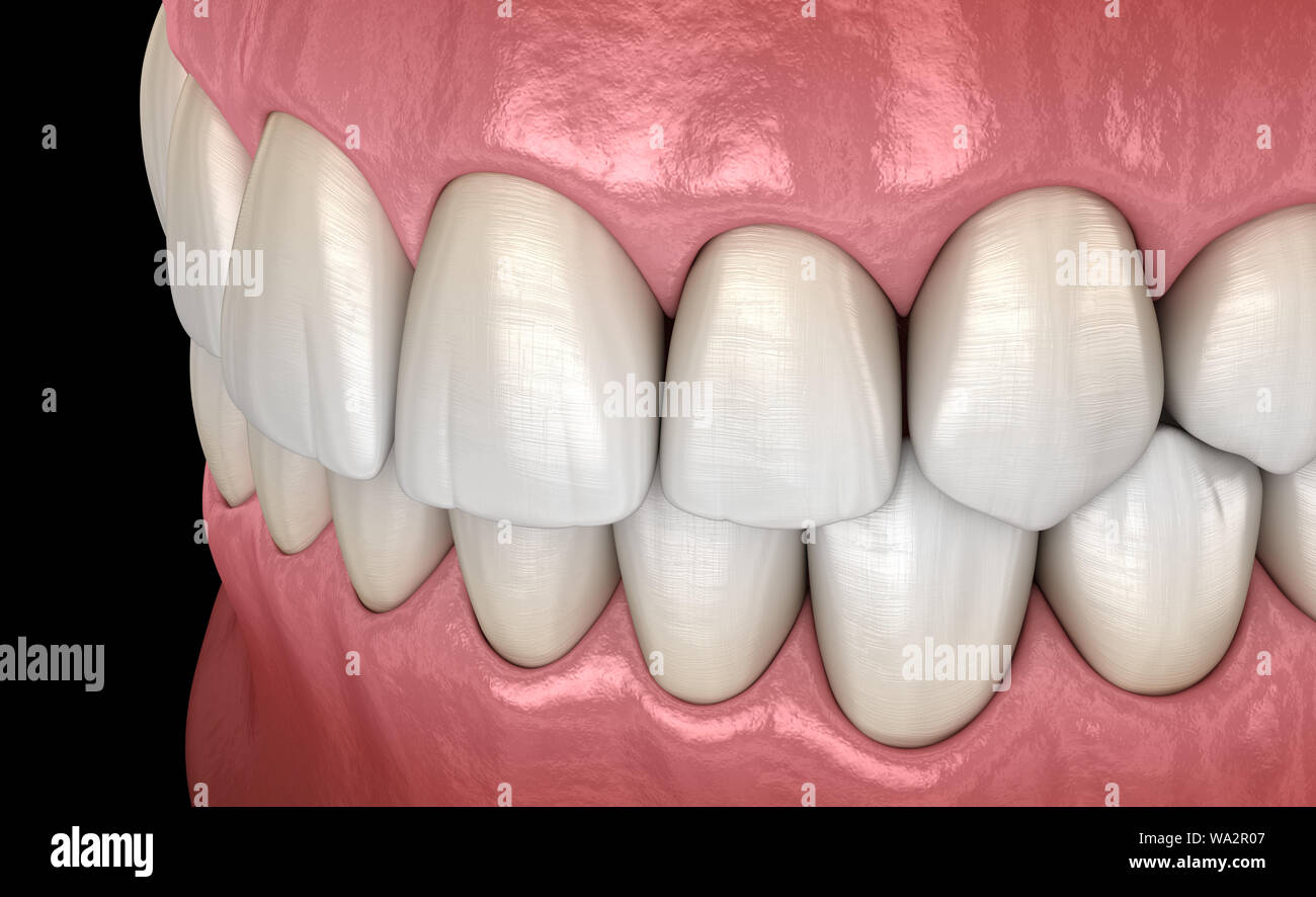 Healthy human teeth with normal occlusion, side view. Medically ...