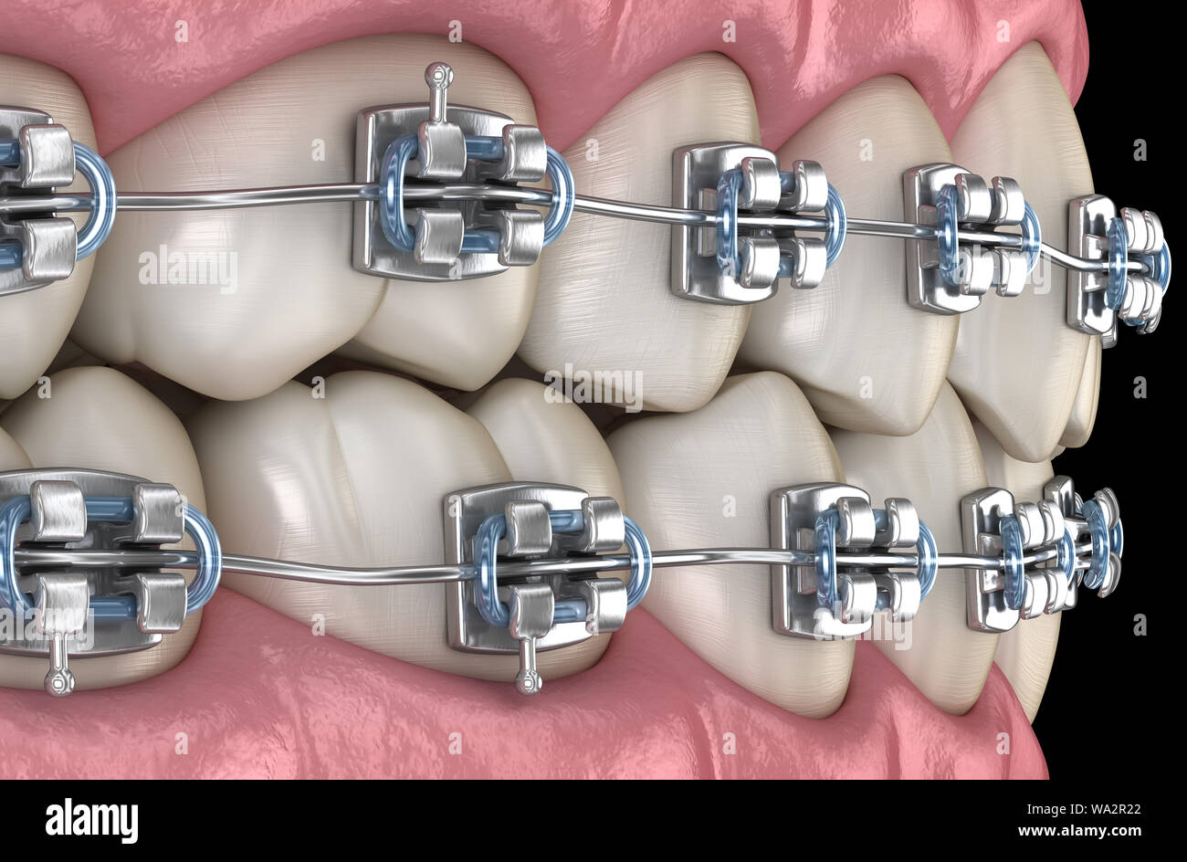 Teeth with metal braces in gums. Medically accurate dental 3D ...