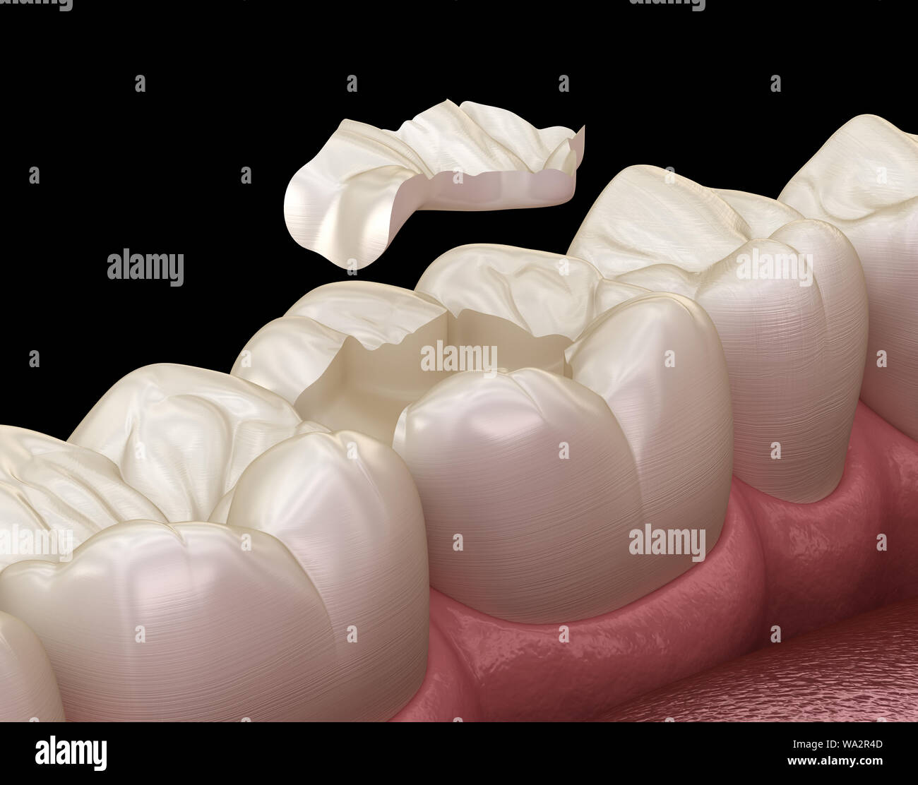 Inlay ceramic crown fixation over tooth. Medically accurate 3D ...