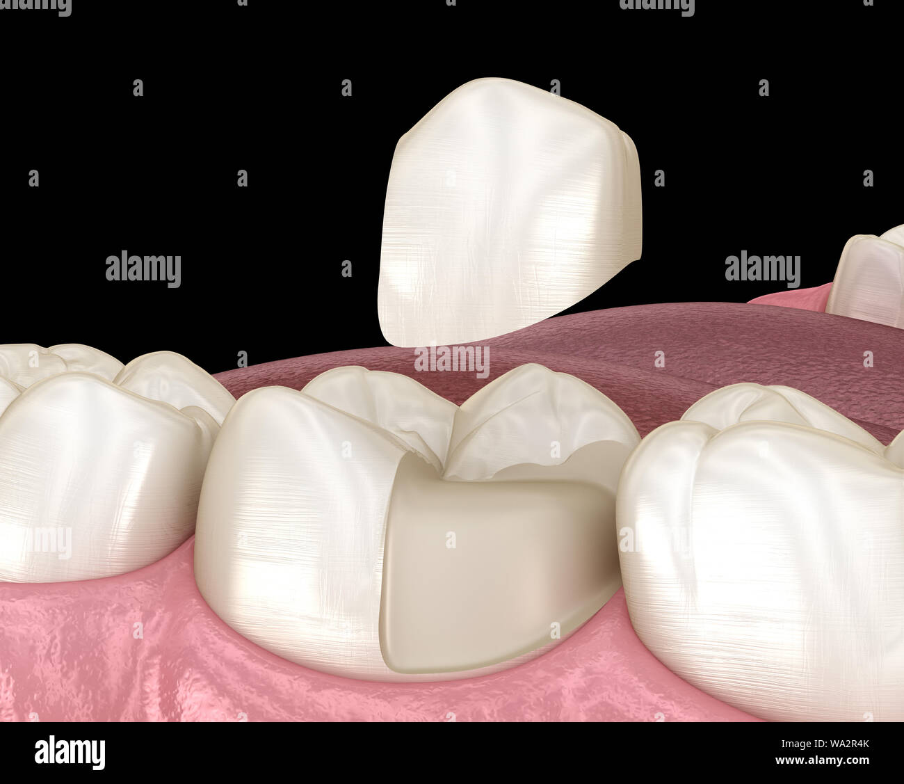 Onlay ceramic crown fixation over tooth. Medically accurate 3D ...