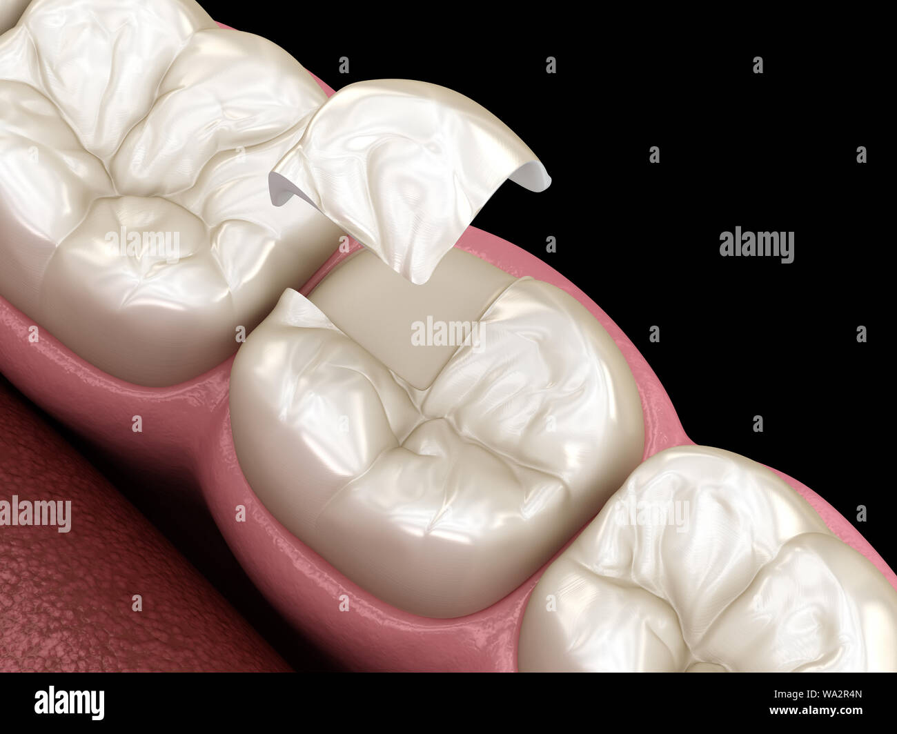 Onlay ceramic crown fixation over tooth. Medically accurate 3D ...