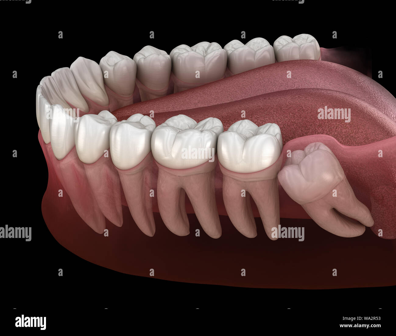 Mesial hi-res stock photography and images - Alamy