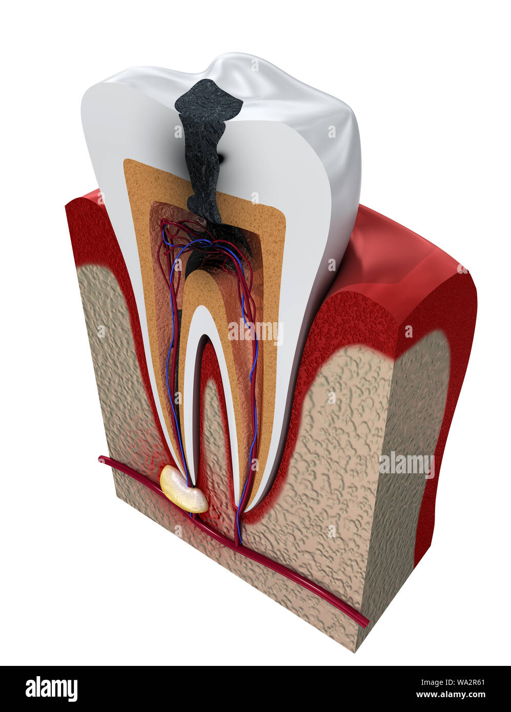 Tooth decay. Medically accurate tooth 3D illustration Stock Photo - Alamy