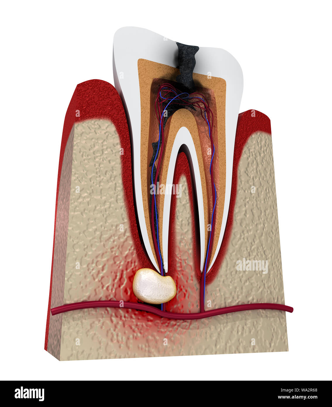 Tooth decay. Medically accurate tooth 3D illustration Stock Photo - Alamy