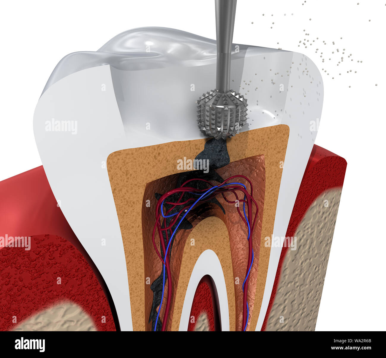 Root canal treatment process. 3D illustration Stock Photo - Alamy