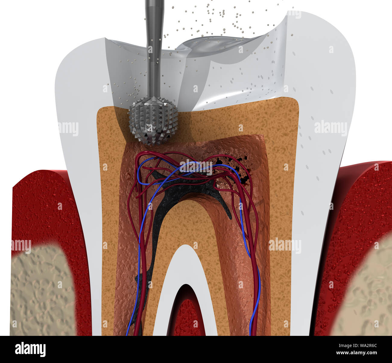 Root canal treatment process. 3D illustration Stock Photo - Alamy