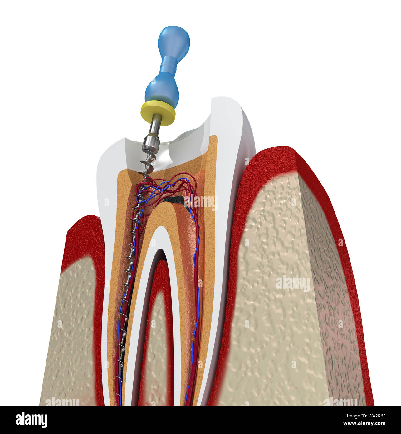 Root canal treatment process. 3D illustration Stock Photo - Alamy