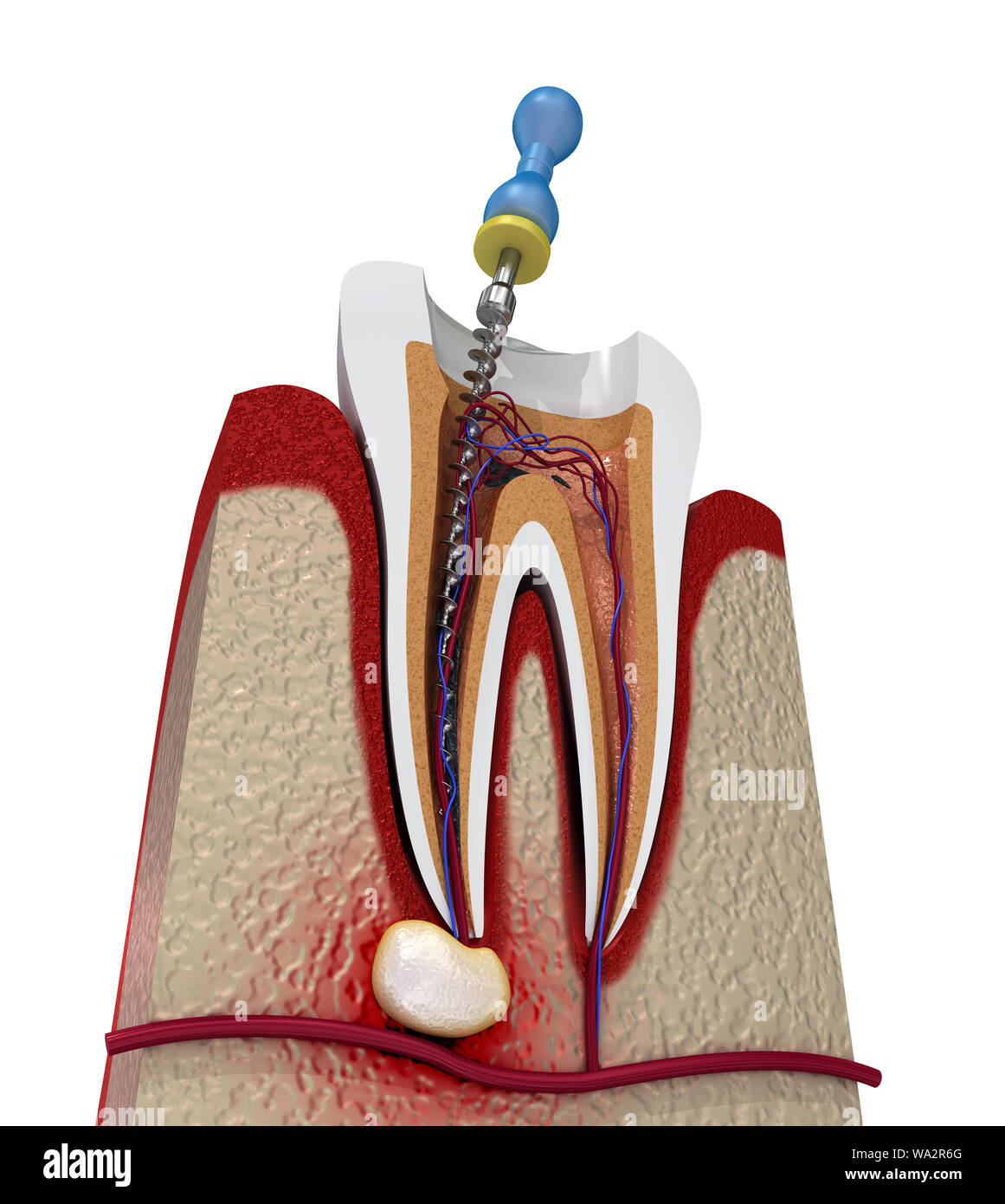 Root canal treatment process. 3D illustration Stock Photo - Alamy