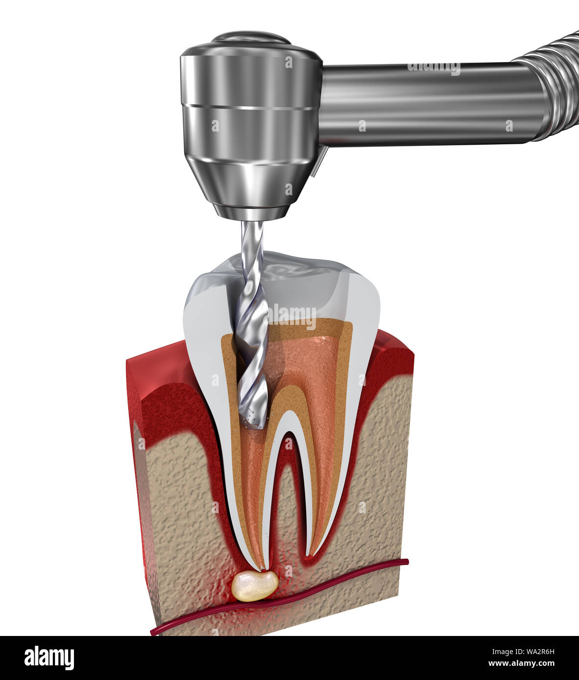 Root canal treatment process. 3D illustration Stock Photo - Alamy
