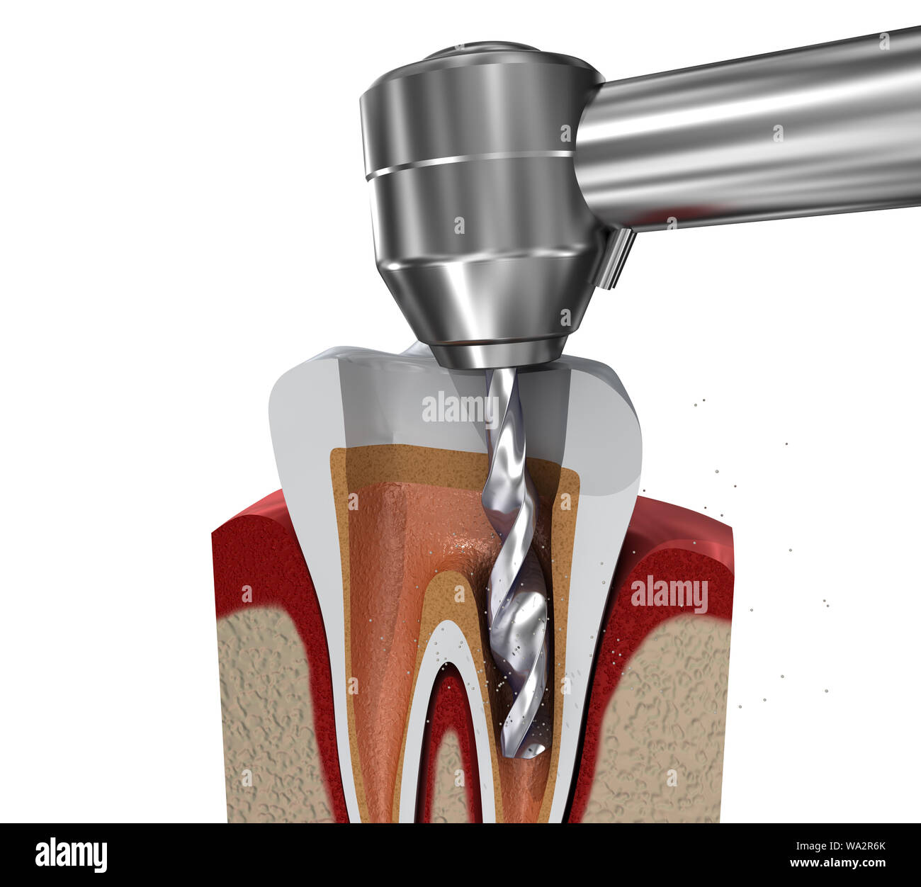 Root canal treatment process. 3D illustration Stock Photo - Alamy