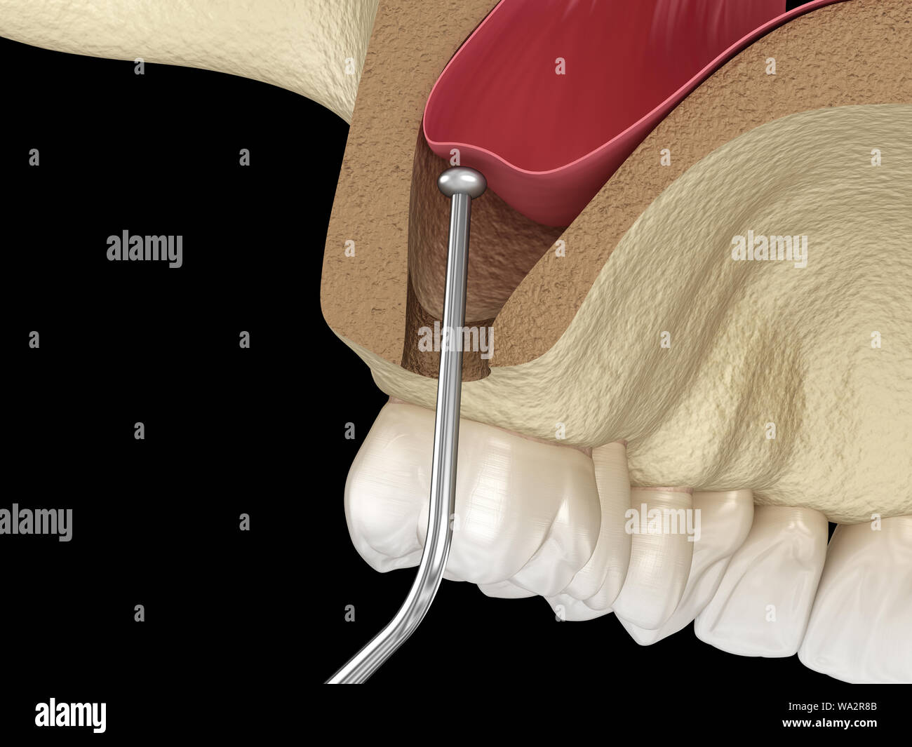 Sinus Lift Surgery - Sinus Augmentation. 3D illustration Stock Photo ...
