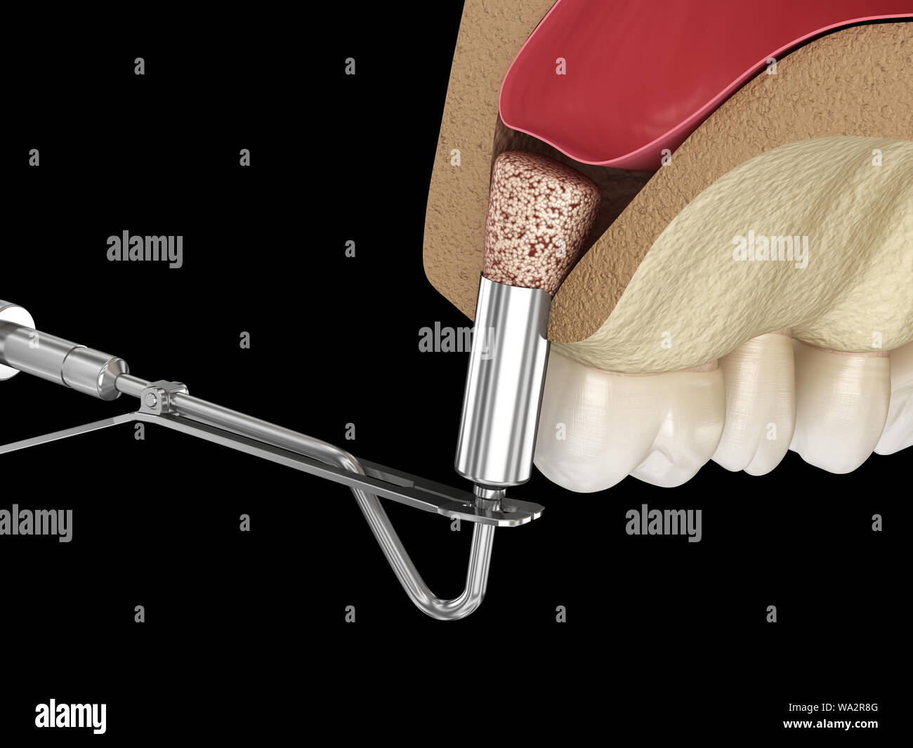 Sinus Lift Surgery - Adding new bone. 3D illustration Stock Photo - Alamy