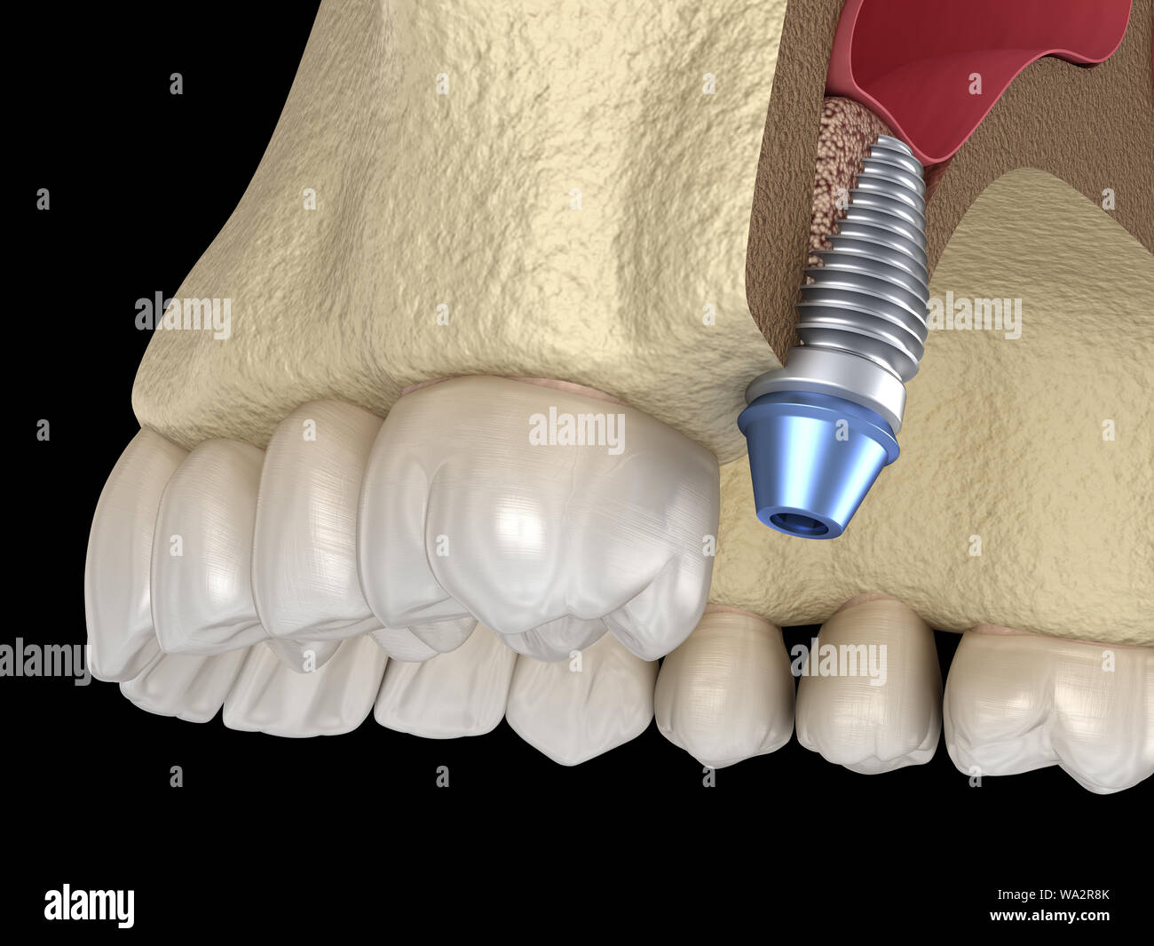 Sinus Lift Surgery - implant installation. 3D illustration Stock Photo ...