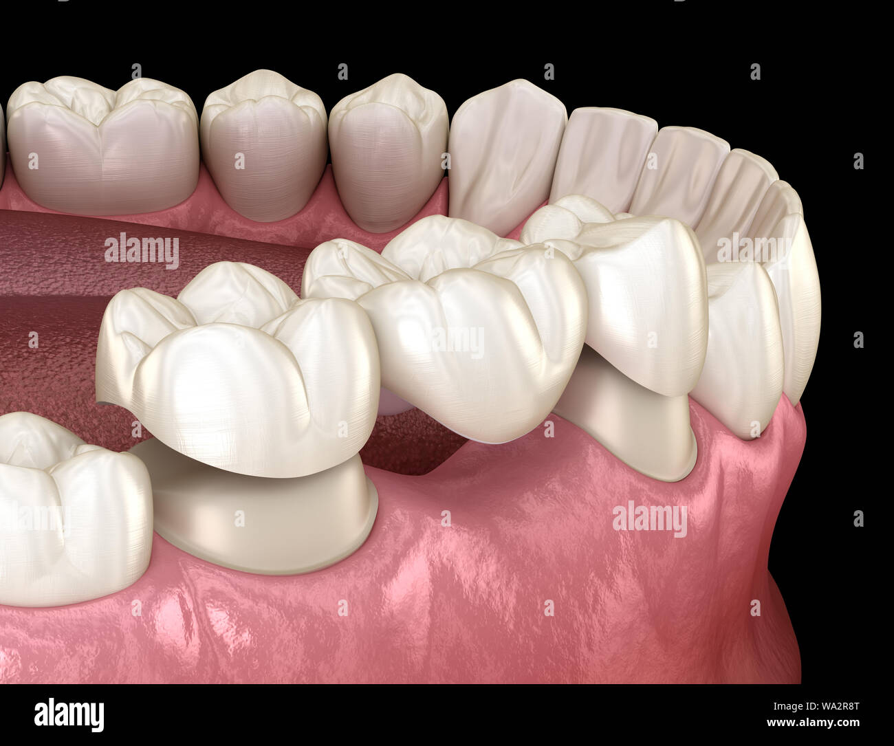 Dental bridge of 3 teeth over molar and premolar. Medically accurate 3D ...