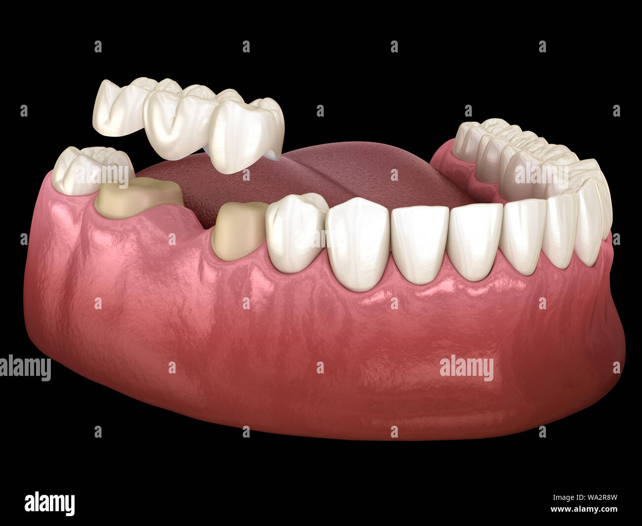 Dental bridge of 3 teeth over molar and premolar. Medically accurate 3D ...