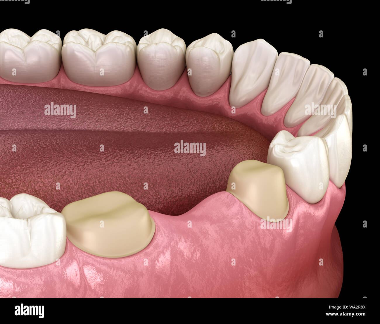 Preparated molar and premolar tooth for dental bridge placement ...