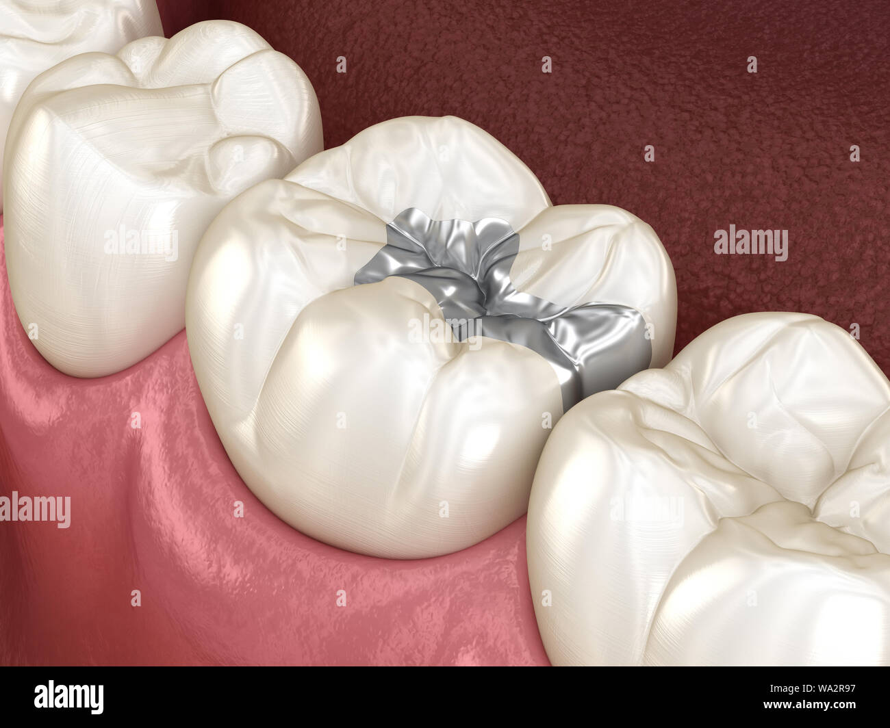 Inlay silver crown fixation over tooth. Medically accurate 3D ...