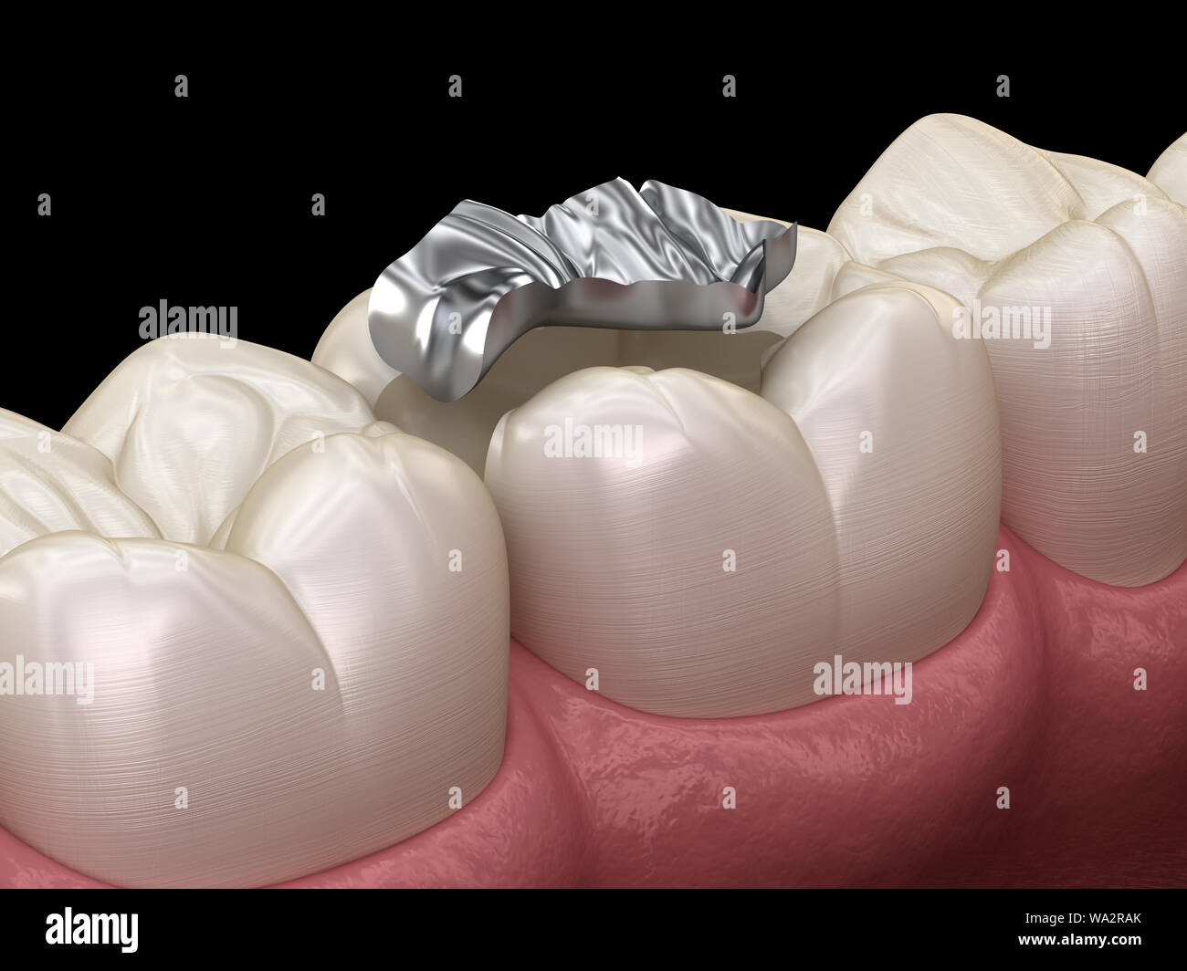 Inlay silver crown fixation over tooth. Medically accurate 3D ...