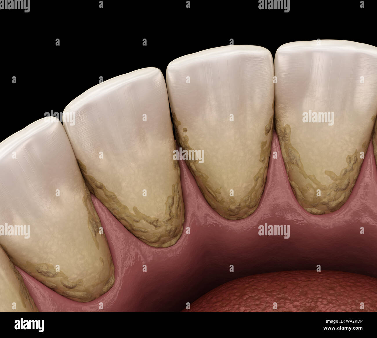 Tartar and bactrail tooth plaque, lower jaw. Medically accurate 3D ...