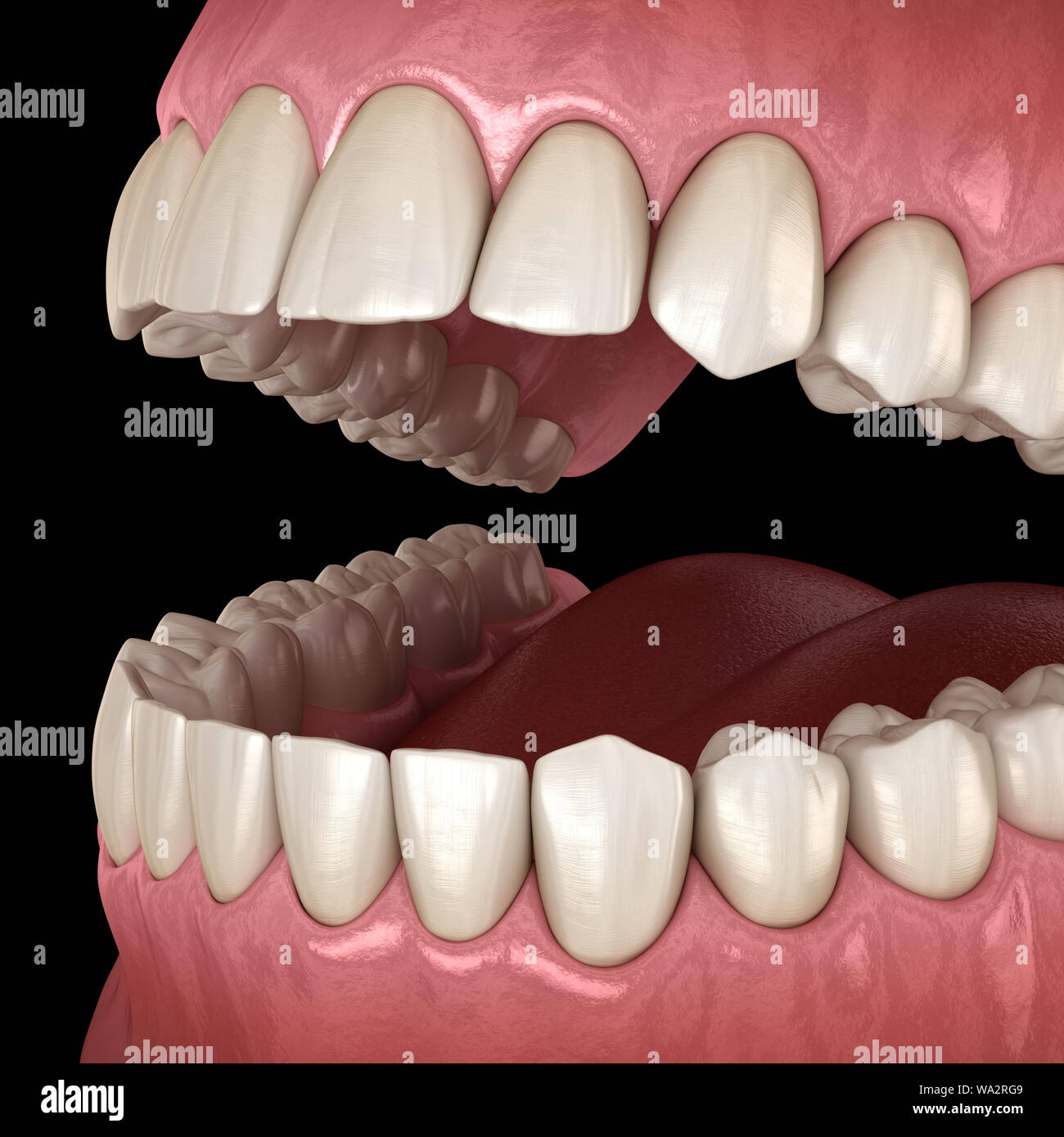 Dental anatomy - Opened Dentures. Medically accurate dental 3D ...
