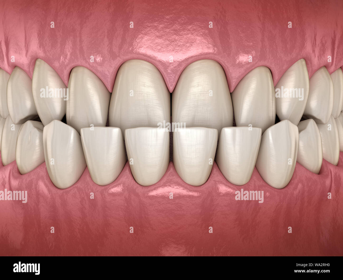 Underbite dental occlusion ( Malocclusion of teeth ). Medically ...