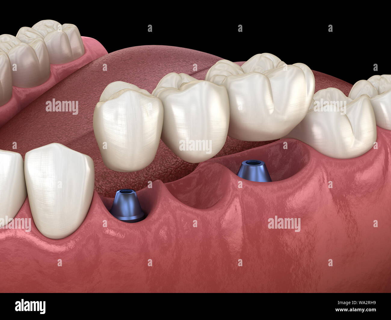 Dental bridge supported by implants. Medically accurate 3D illustration ...