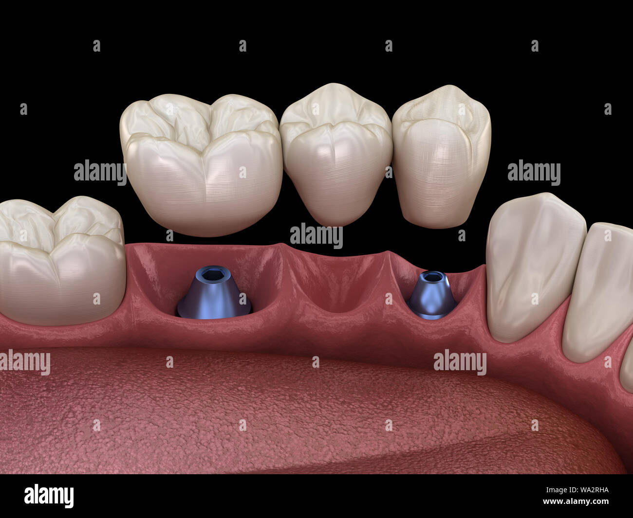 Dental bridge supported by implants. Medically accurate 3D illustration ...