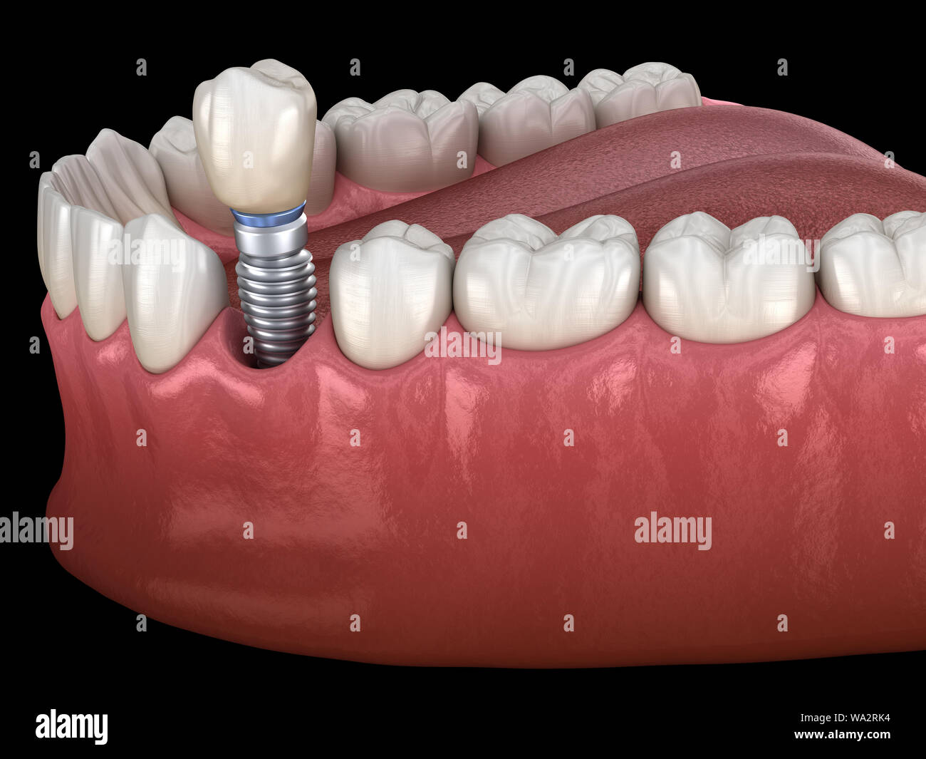 Premolar tooth crown installation over implant abutment. Medically ...