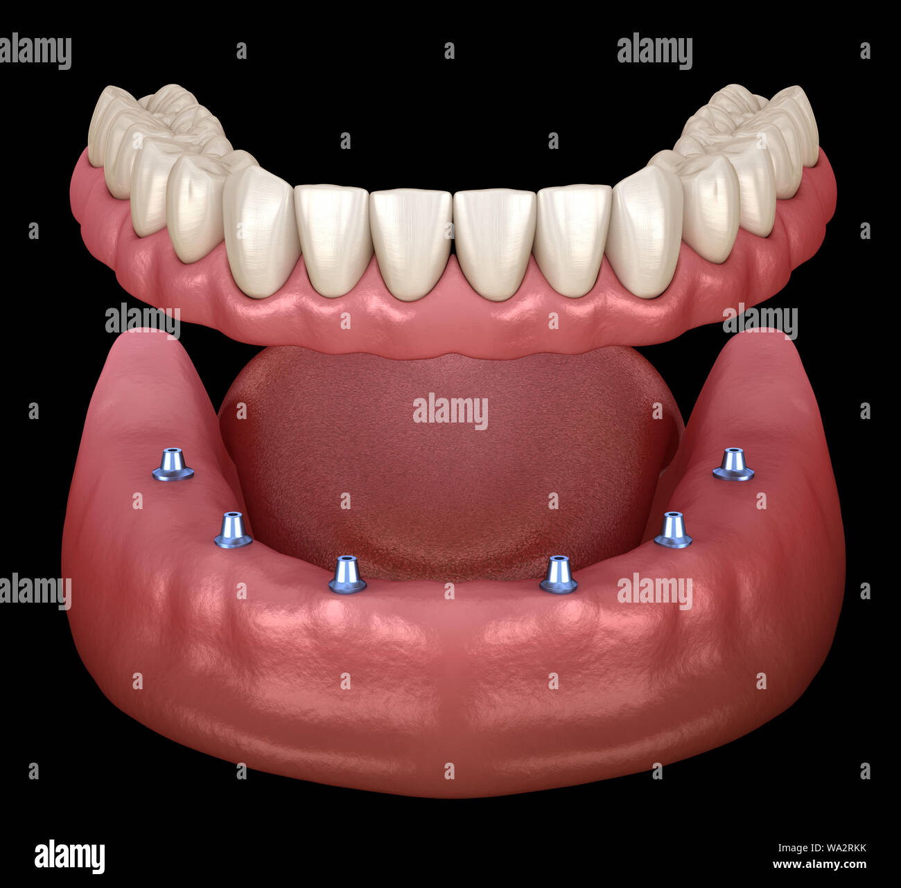 Mandibular prosthesis All on 6 system supported by implants. Medically ...