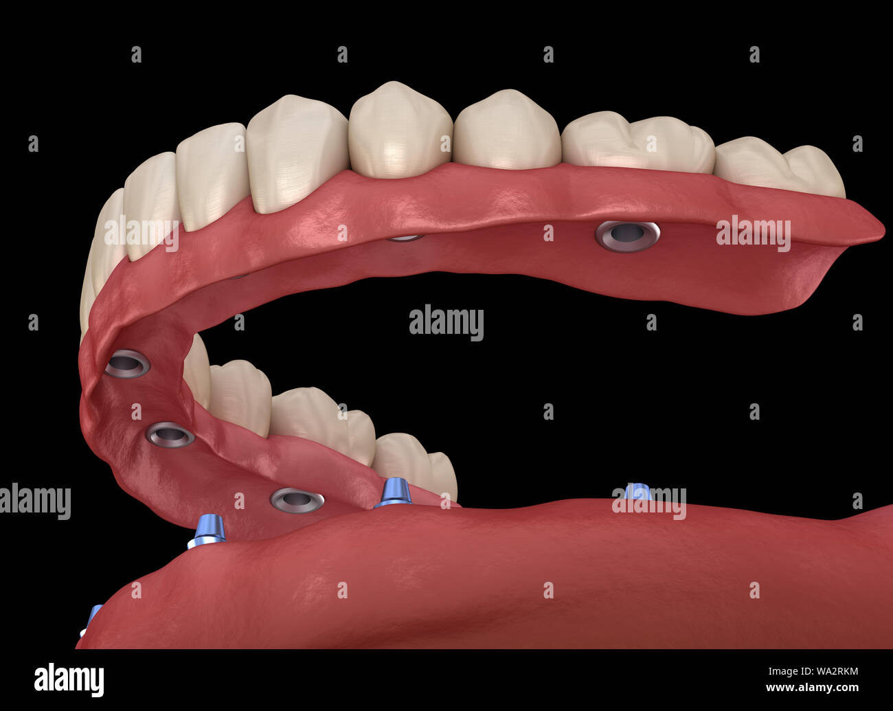 Mandibular prosthesis All on 6 system supported by implants. Medically ...