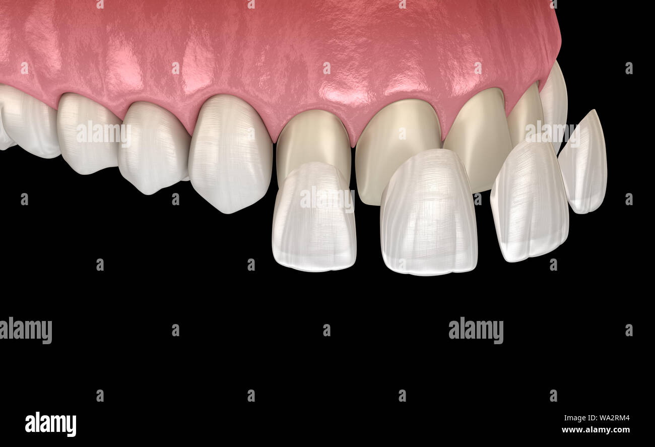 Lateral incisor hi-res stock photography and images - Alamy